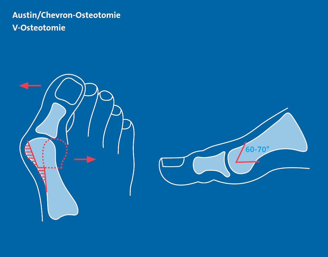 Chevron Osteotomie